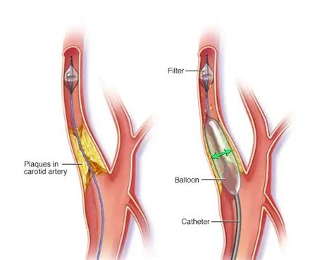Radical Prostatectomy Cure 2 World