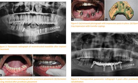 Figure 4 From Rehabilitation Using Implants In Free Fibula Flap Of A Patient With Ameloblastoma