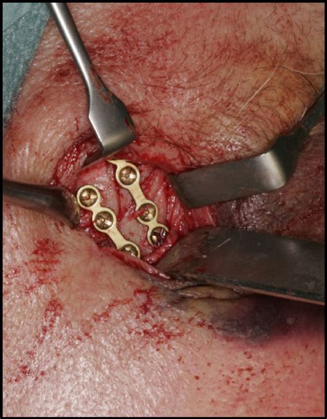 Fig 6 Adequate Anatomic Alignment And Fixation With Mini Plates At