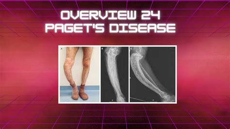 Pagets Disease Patient Stories At Jon Lefebre Blog