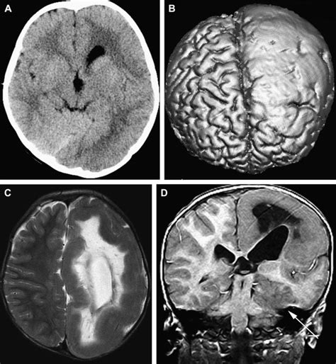 Development And Dysgenesis Of The Cerebral Cortex Malformations Of Cortical Development