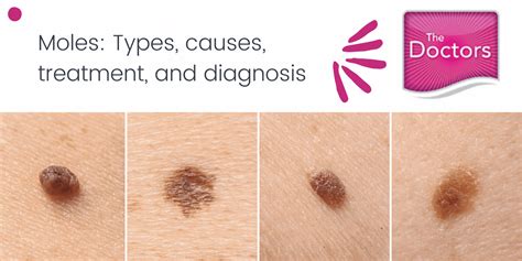 Moles Demystified Types Causes And Diagnosis