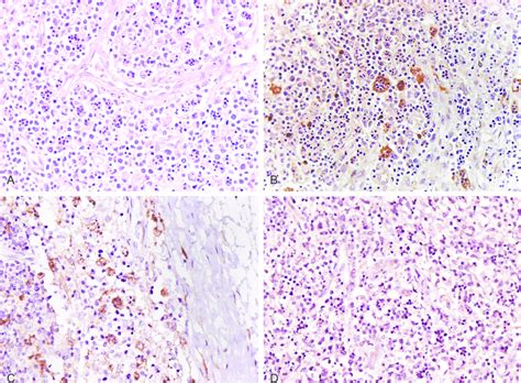 Photomicrography Of The Lymph Node Showing In A Histiocytic Cells