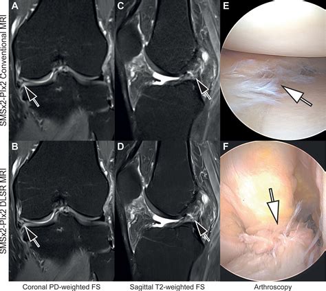 Deep Learning Superresolution For Simultaneous Multislice Parallel Imagingaccelerated Knee Mri