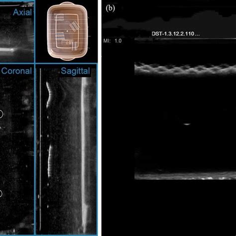A Three Orthogonal Plan Views Of Abus Imaging Of The Ultrapro Tm Mesh