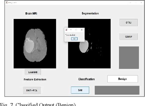 Figure 7 From Svm Based Brain Tumor Detection And Classification System Semantic Scholar