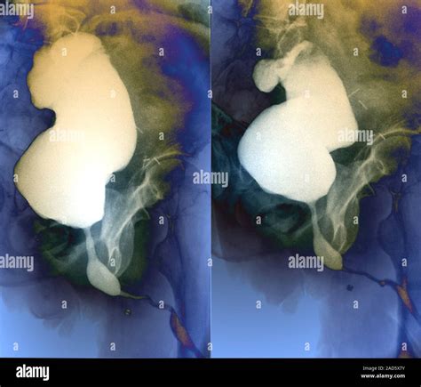 Augmented Bladder Coloured Retrograde Cystography Images Bladder X