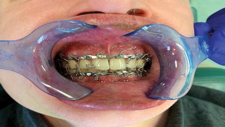 Wiring A Jaw Shut