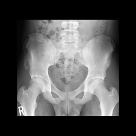 Pediatric Pelvis Fracture Pediatric Radiology Reference Article