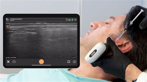 Ultrasound Guided Botox Injections A Safer More Effective Approach Clarius