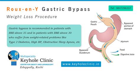 Roux En Y Gastric Bypass Surgery In Kochi Bariatric Surgery
