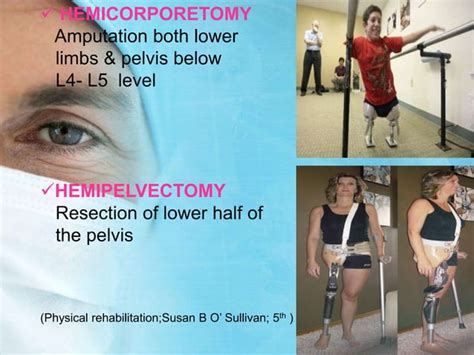 Amputationstump Care Phantom Limb Pain And Gait Training In Lower