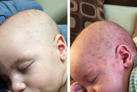 Measles Infections And Symptoms Pose Far More Longterm Risks Than Most Realize
