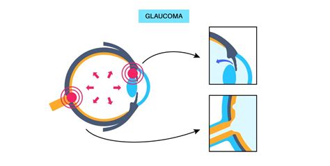 glaucoma eye disease royalty free vector image