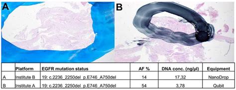 Macrodissection Tumor Cells On Hande Stained Slides Were Marked By
