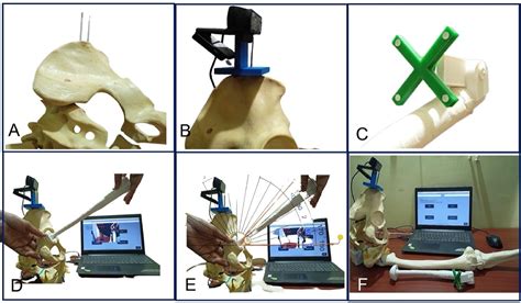 The Economical And Reliable Image Free Navigation System For Acetabular Cup Implantation In