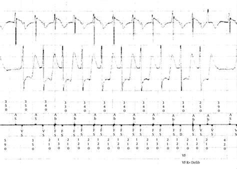 Initial Interrogation Of The Implantable Cardioverter Defibrillator Download Scientific Diagram