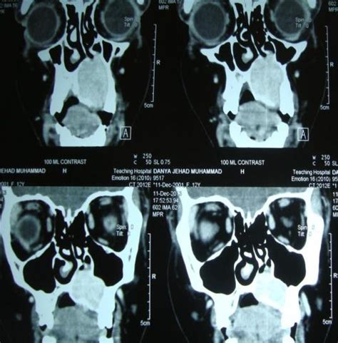 Patients Ct Showing Bone Destructive Lesion Involved Left Side Of