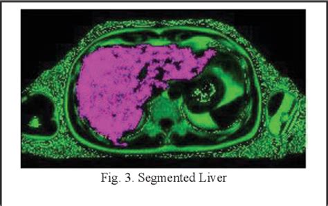 Figure 3 From Automatic Liver And Subcutaneous Fat Segmentation From