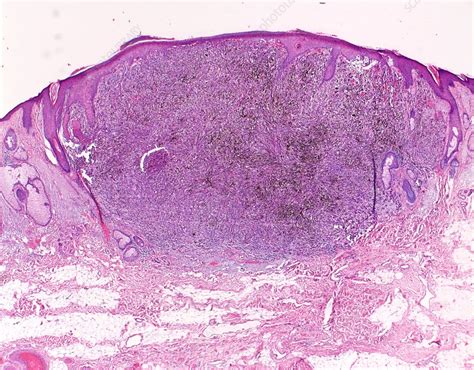 Nodular Melanoma Light Micrograph Stock Image C051 1640 Science Photo Library