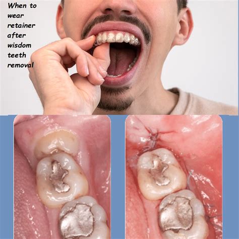 After Wisdom Teeth Removal Wisdom Teeth Removal Spectrum Health