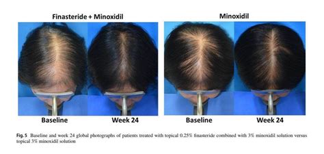 Finasteride Vs Minoxidil Which Hair Loss Treatment Is Right For You