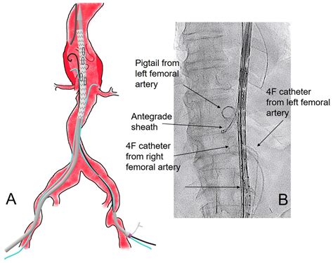 Femoral Sheath Catheter