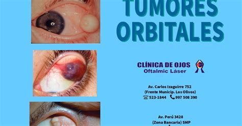 Clínica De Ojos Oftalmic Láser Tumores Orbitales