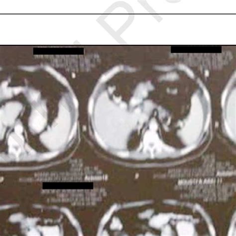 Upper Gastrointestinal Series A Andb A Fistula Between The 2 Nd