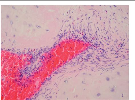 Figure 1 From Eosinophilict Cell Chorionic Vasculitis And Intrauterine Fetal Demise At 34 Weeks