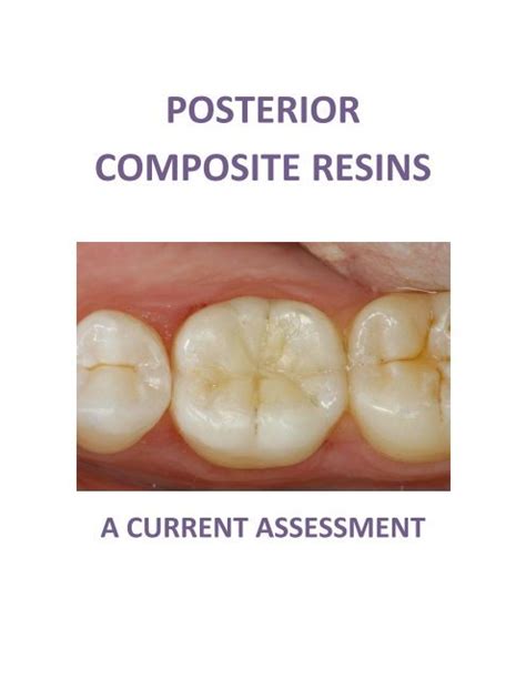 Posterior Composite Resins Surefil Sdr Flow From Dentsply Caulk
