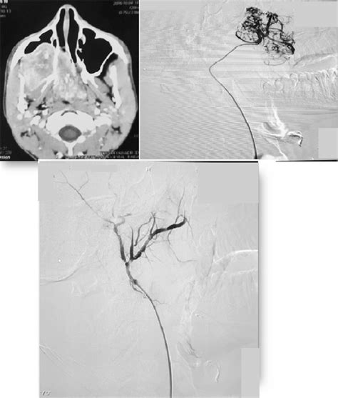 16 Years Male Presented With Recurrent Episodes Of Epistaxis And Nasal