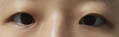 눈매교정 앞트임 후기입니다 리얼후기 눈이 예쁘다 그래서 아몬드성형외과