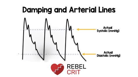 Arterial Line Venous Arterial Line Set Unilene Arterial Line Venous Arterial Line Set Unilene