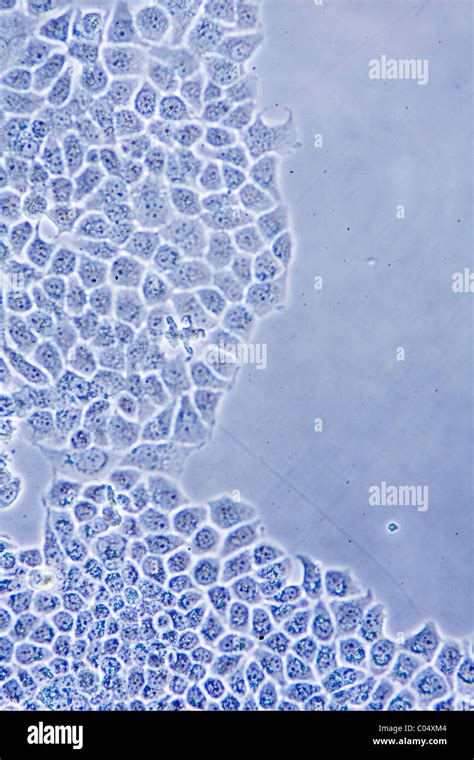 Cancer Cells Under A Microscope