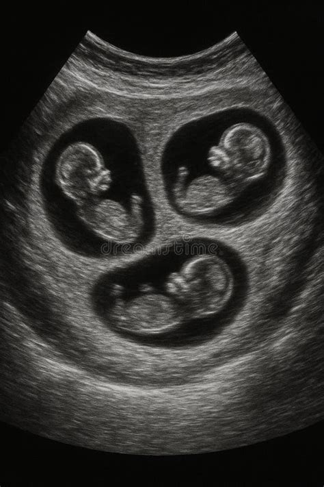 Embryos Triplets Stock Illustrations 1 Embryos Triplets Stock