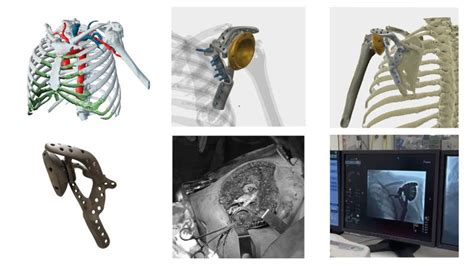 Chondrosarcoma Scapula Patientspecific Customimplant Osteosarcoma Sarcoma Oncology