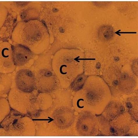 Giemsa Stained 30 Day Old Monocyte Culture Of A 22 Year Old