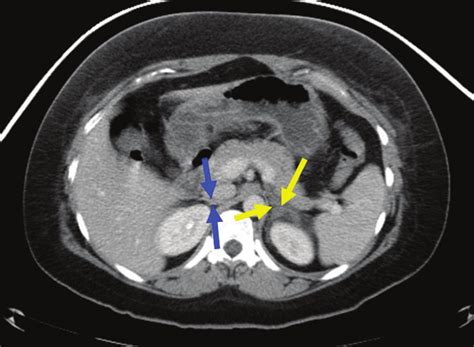 Cross Sectional Abdominal Ct Scan With Thickening And Stranding Yellow