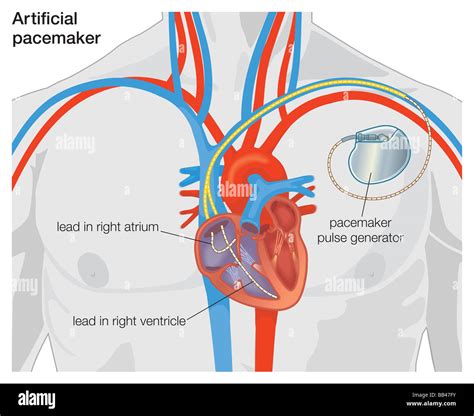 Artificial Heart Diagram