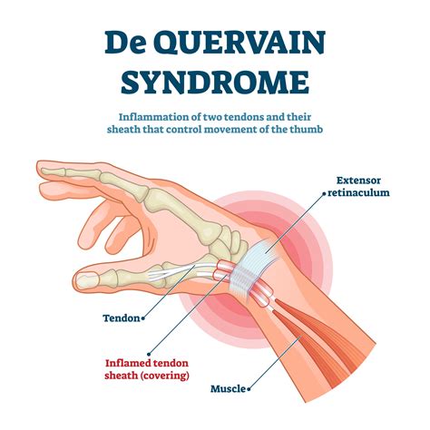 Carpal Tunnel Syndrome Treatment And Relief Aptiva Health