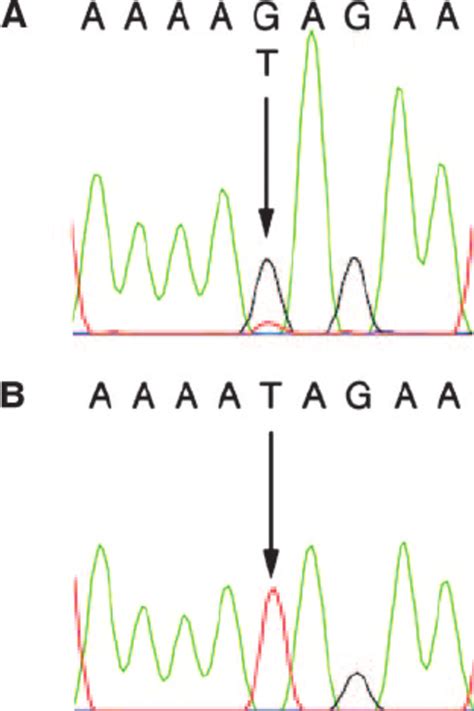 Somatic G To T Transversion Mutation In Apc Resulting In A Termination Download Scientific