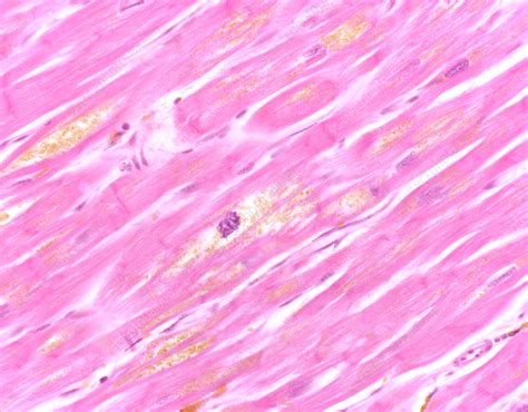 Hemochromatosis Light Micrograph Stock Image C0577070 Science