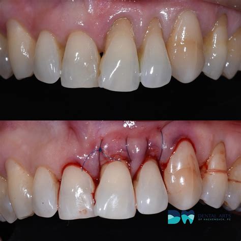 Dental Connective Tissue Graft This Is The Most Common Method Used To Treat Root Exposure