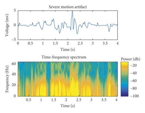The Time Frequency Spectrum For Five Types Of Dynamic Ecg Signals