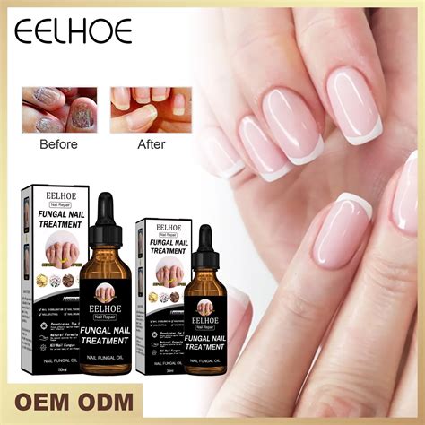 Eelhoe 그레이 네일 리페어 리퀴드 오목한 볼록 소프트 네일 두꺼운 그레이 네일 리페어 리퀴드 풋 매니큐어 케어 리퀴드