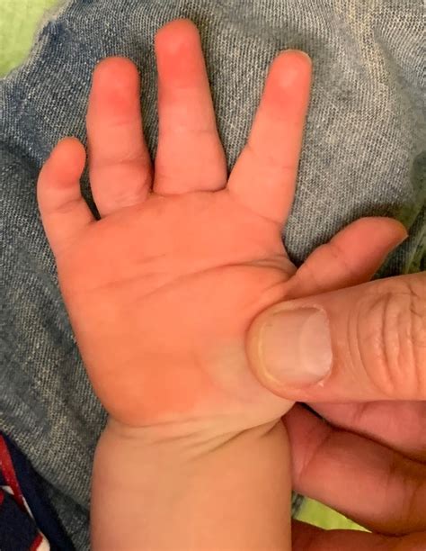 Syndactyly The Type Matters Congenital Hand And Arm Differences