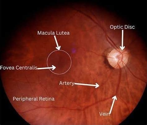 The Ultimate Guide To Identifying Retinal Disease On Fundus Photography