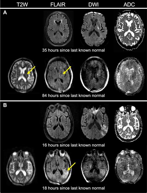 Monitoring Of Ischemic Stroke Development With Pmri A A 66 Year Old