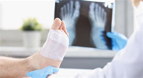 ¿cuánto Tiempo Tarda En Curarse Una Fractura En La Falange De Un Pie